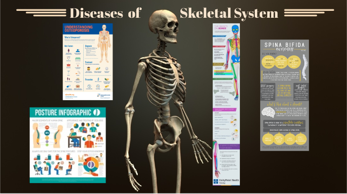 skeletal system diseases by csim sim on Prezi