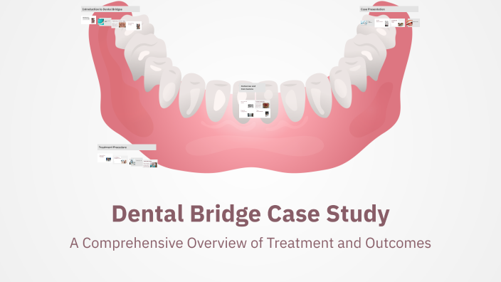 Dental Bridge Case Study by on Prezi
