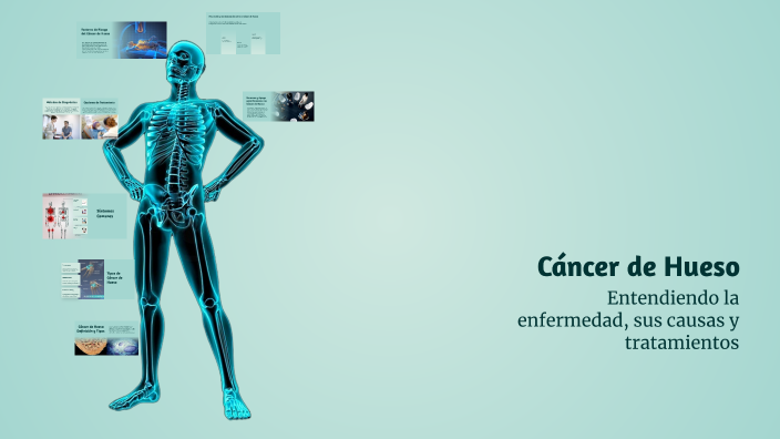 Cáncer de Hueso by Luis Obed Fernandez on Prezi
