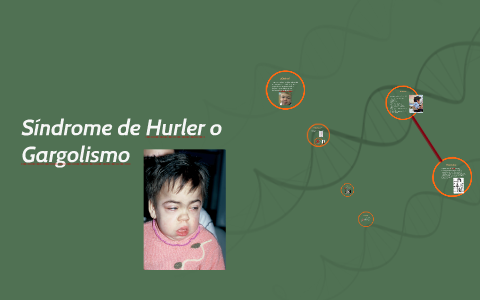 Síndrome de Hurler o Gargolismo by Cynthia Garibay on Prezi