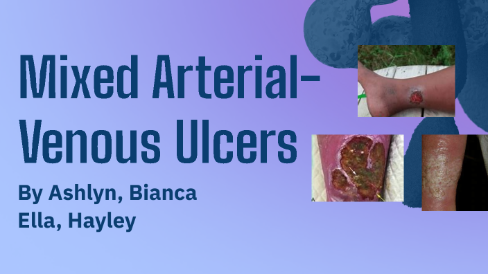Mixed Arterial- Venous Ulcers by Ella Hobson on Prezi
