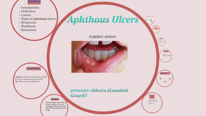 Aphthous Ulcers by athraa al saadi on Prezi