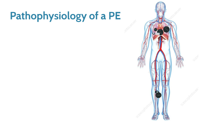 Pathophysiology of a PE by Katie Barwitzki on Prezi
