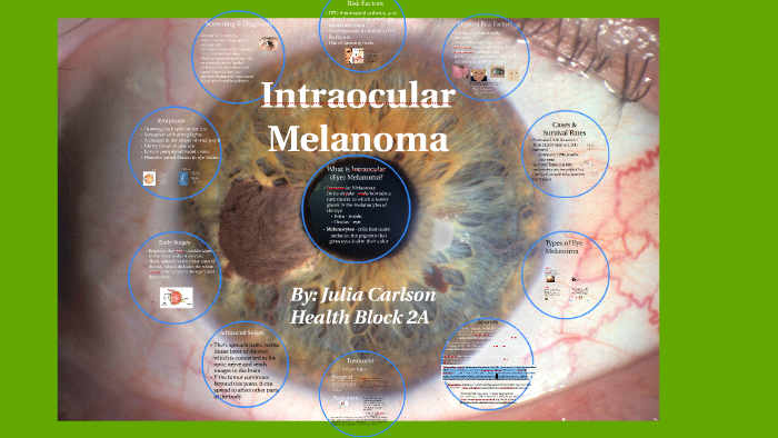 Intraocular Melanoma by Julia Carlson on Prezi