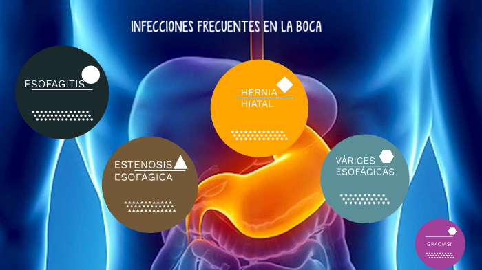 Infecciones frecuentes en la boca by Ale Guzmán on Prezi