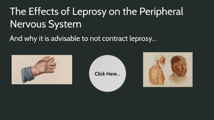 The Effects of Leprosy on the Peripheral Nervous System by Nathan ...