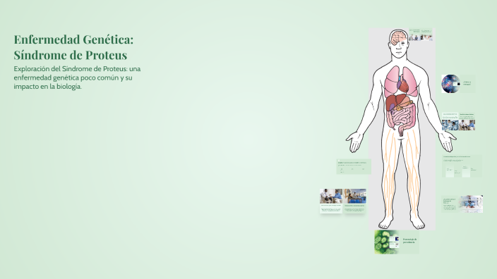 Enfermedad Genética: Síndrome de Proteus by MARSE GOMA on Prezi