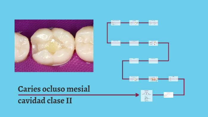 Caries ocluso mesial cavidad clase II by Lidia Martin on Prezi