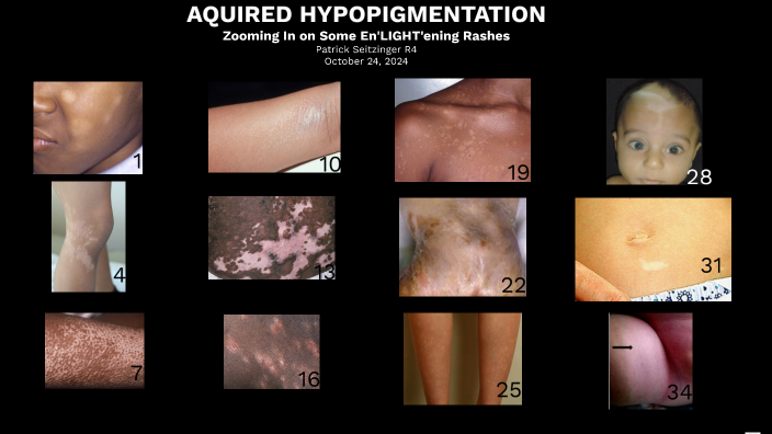 Hypopigmentation in Children by Lupin Lupin on Prezi