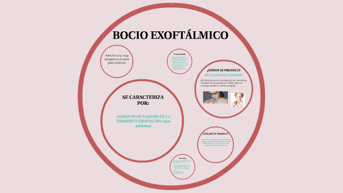 BOCIO EXOFTÁLMICO by litzy alondra mariscal on Prezi