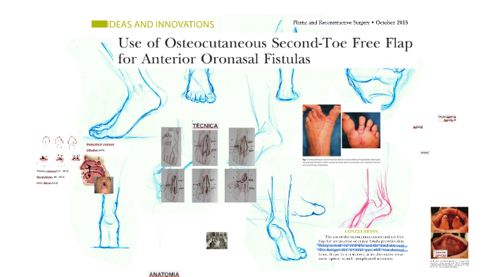 2nd-toe free flap for oronasal fistulas by J.Pablo Garnica Garcia on Prezi