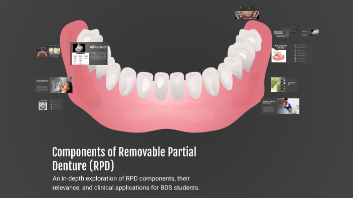 Components of Removable Partial Denture (RPD) by maryam shaikh on Prezi