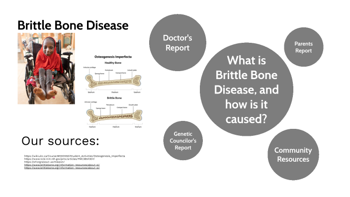Brittle Bone Presentation by CASEY COLONIA on Prezi