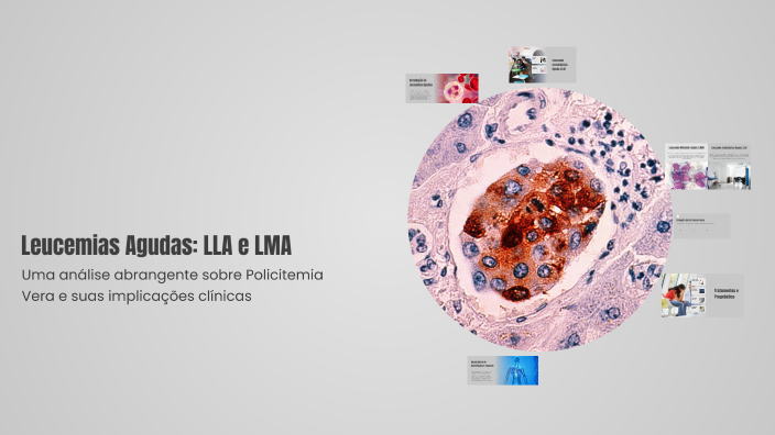 Leucemias Agudas: LLA e LMA by Fabrícia on Prezi