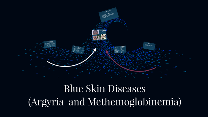 Blue Skin Diseases by Emma Stebbing on Prezi