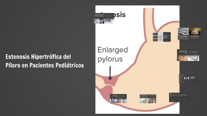 Estenosis Hipertrófica del Píloro en Pacientes Pediátricos by Alberto ...