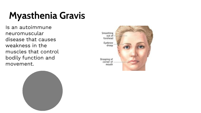 Myasthenia Gravis by Jaylan Wells on Prezi