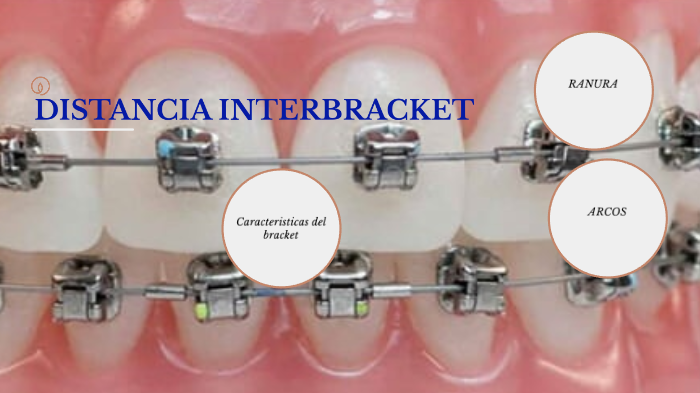 DISTANCIA INTERBRACKET by Fatima Gutierrez on Prezi