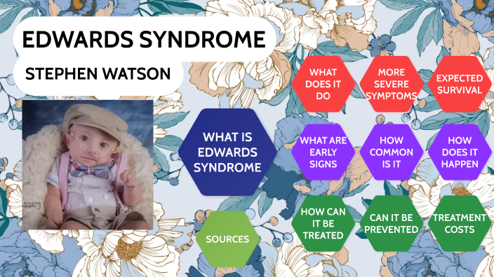 EDWARDS'S SYNDROME by Stephen Watson on Prezi
