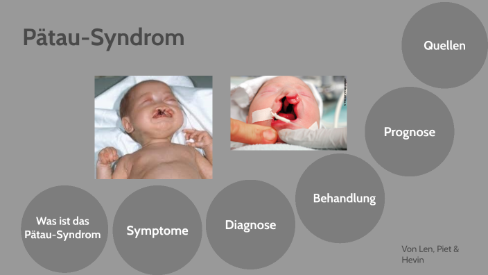 Kopie von Pätau-Syndrom by Hevin Cuskun on Prezi