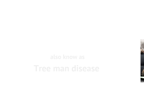 Epidermodysplasia verruciformis which is also known as Tree man disease ...