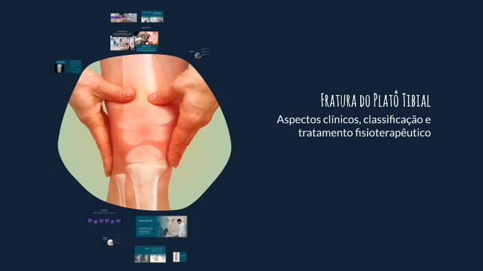 Fratura do Platô Tibial by Karla Mellyne on Prezi