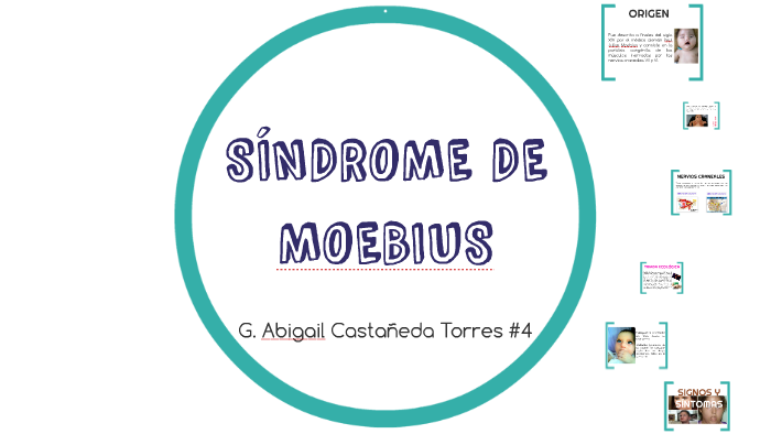 SÍNDROME DE MOEBIUS by Abi Castañeda on Prezi