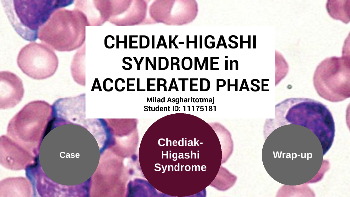 Chediak-Higashi Syndrome in accelerated phase by Milad Asgharitotmaj on ...