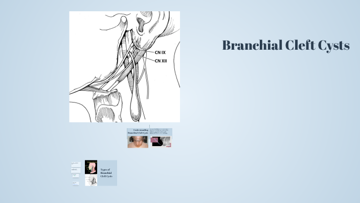 Understanding Branchial Cleft Cysts by mohamed emad on Prezi