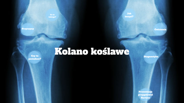 Kolano koślawe by Takedziu on Prezi
