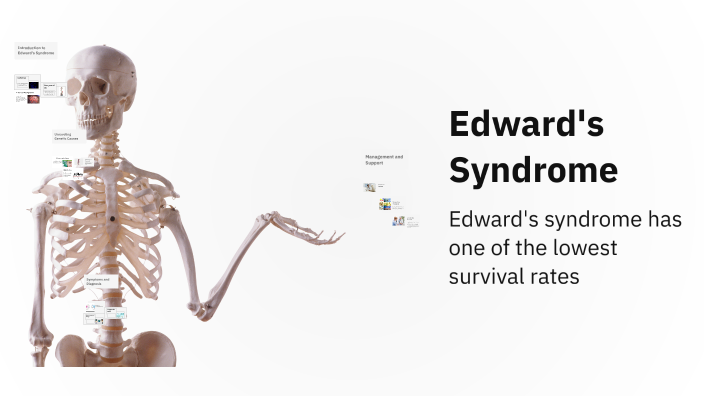 Edward's Syndrome by Graham Vredeveld on Prezi