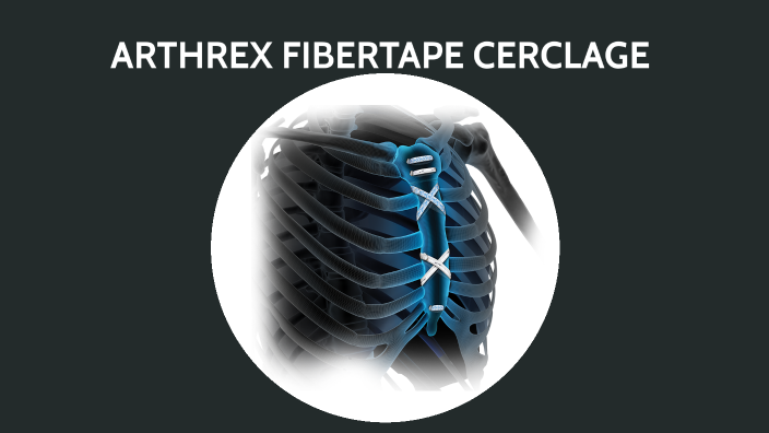 ARTHREX FIBERTAPE CERCLAGE by Michael Gonzalez on Prezi
