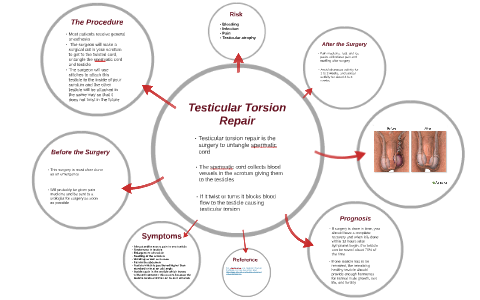 Testicular Torsion Procedure by Roberto Vasquez on Prezi