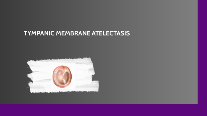 TYMPANIC MEMBRANE ATELECTASIS by Jacqui W on Prezi