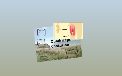 Quadriceps Contusion by Catherine Bopp on Prezi