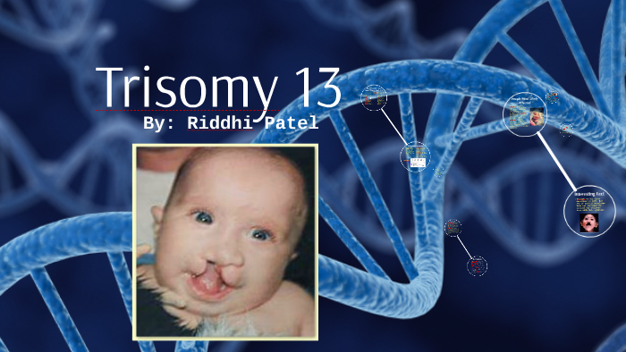 Trisomy 13 Syndrome Characteristics