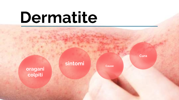 Dermatite by Albi Spaneshi on Prezi