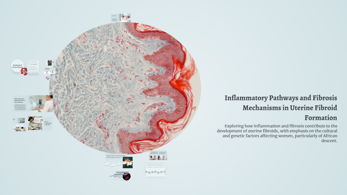 Inflammatory Pathways and Fibrosis Mechanisms in Uterine Fibroid ...