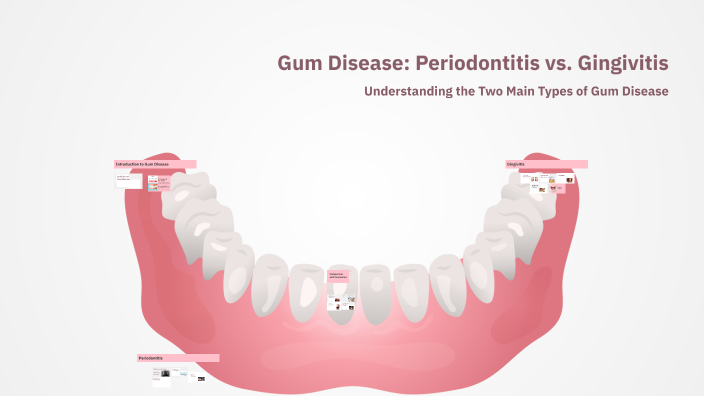 Gum Disease: Periodontitis vs. Gingivitis by Aisha Harris on Prezi