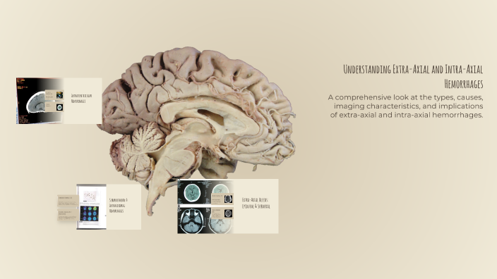 Understanding Extra-Axial and Intra-Axial Hemorrhages by Bdrann on Prezi