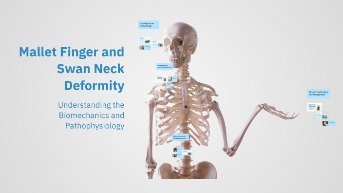 Mallet Finger and Swan Neck Deformity by math del on Prezi