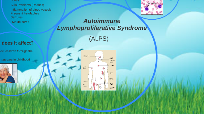 Autoimmune lymphoproliferative Syndrome by Carson Bowman on Prezi