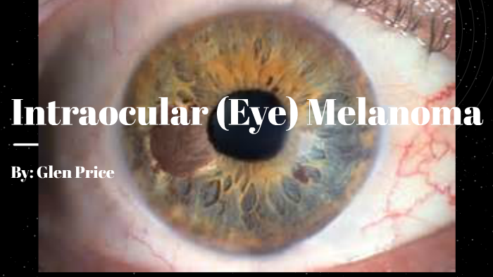 Intraocular (Eye) Melanoma by glen price