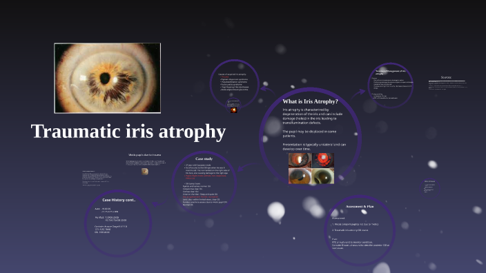 Traumatic iris atrophy by on Prezi