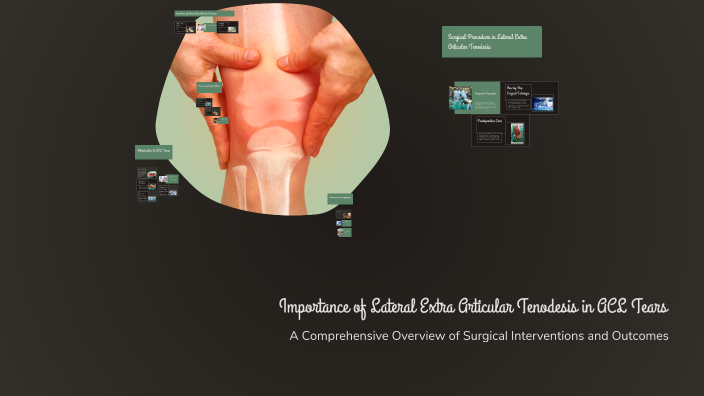 Importance of Lateral Extra Articular Tenodesis in ACL Tears by mohit ...