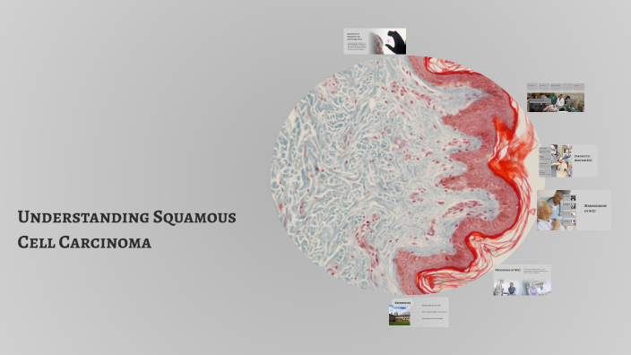 Understanding Squamous Cell Carcinoma by D. ADAM HATEM on Prezi