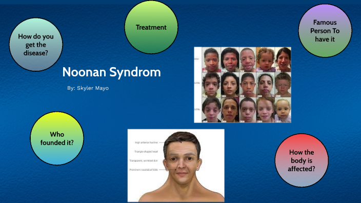 Noonan Syndrome by Skyler Mayo on Prezi