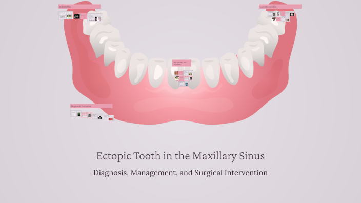 Ectopic Tooth in the Maxillary Sinus by cindy cruz on Prezi