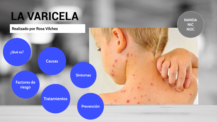 La varicela by Rosa Natalia Vílchez Nágera on Prezi