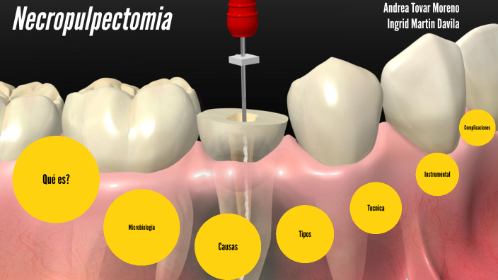 Necropulpectomia by ANDREA TOVAR MORENO on Prezi